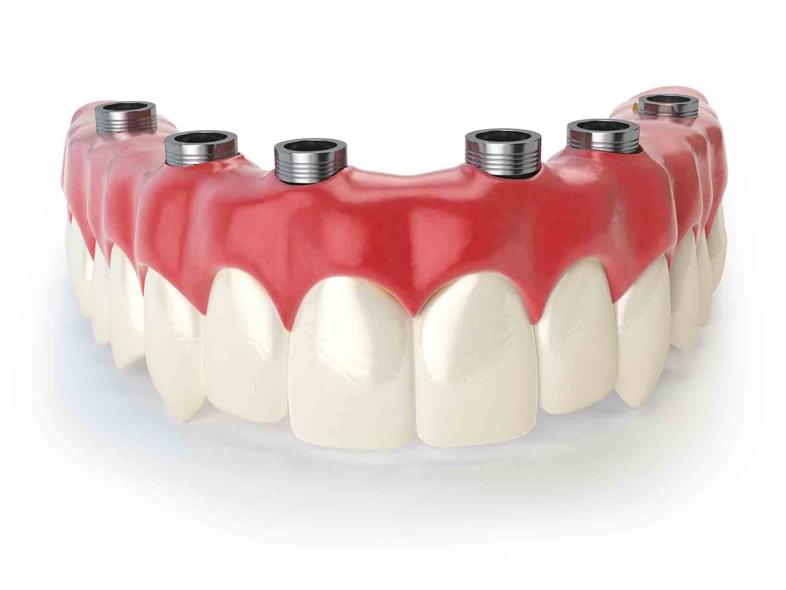 4 or 6 Implant Smile - Villages Lake Deaton Dental